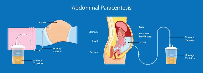 Ascites Causes Pictures Symptoms And Treatment