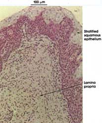 Urethral Caruncle Histology