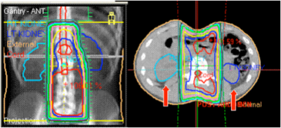 Three-dimensional (3D) Conformal Radiation Therapy | OncoLink