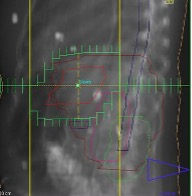 Three-dimensional (3D) Conformal Radiation Therapy | OncoLink